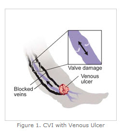 Chronic Venous Insufficiency | UCSF Department of Surgery